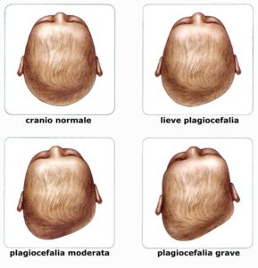 plagiocefalia – CRANIO-SACRAL REPATTERNING