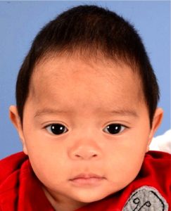 scafocefalia – CRANIO-SACRAL REPATTERNING